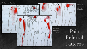 Hip Pain | The Easy Fix – Personal Training North Vancouver